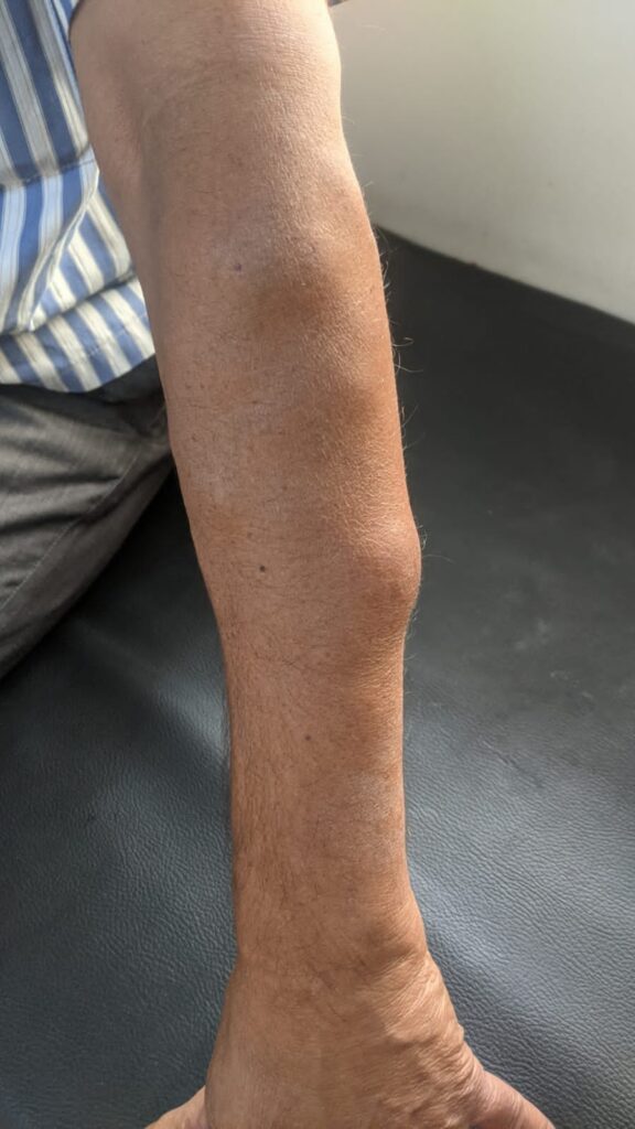 Lipoma - Frequently Asked Questions - Dr Vivek Baliga